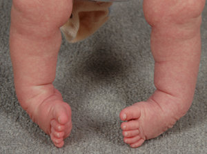 Chromosomal abnormality found for inherited clubfoot - The Source - WashU