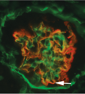 Mouse study shows potential for gene therapy in Alport syndrome, an ...