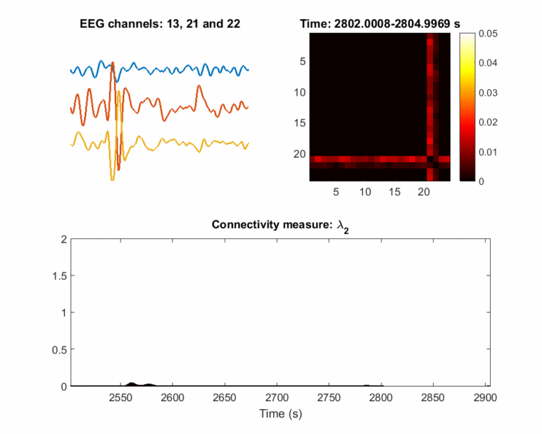 Artificial intelligence identifies, locates seizures in real-time - The ...