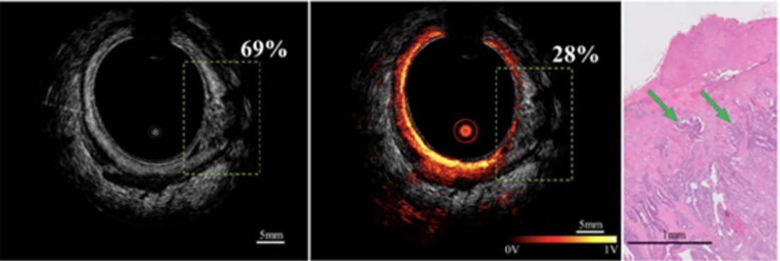 ‘Leap forward’ in risk management of rectal cancer - The Source - WashU
